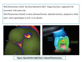 Early diagnosis of caries | PPTX