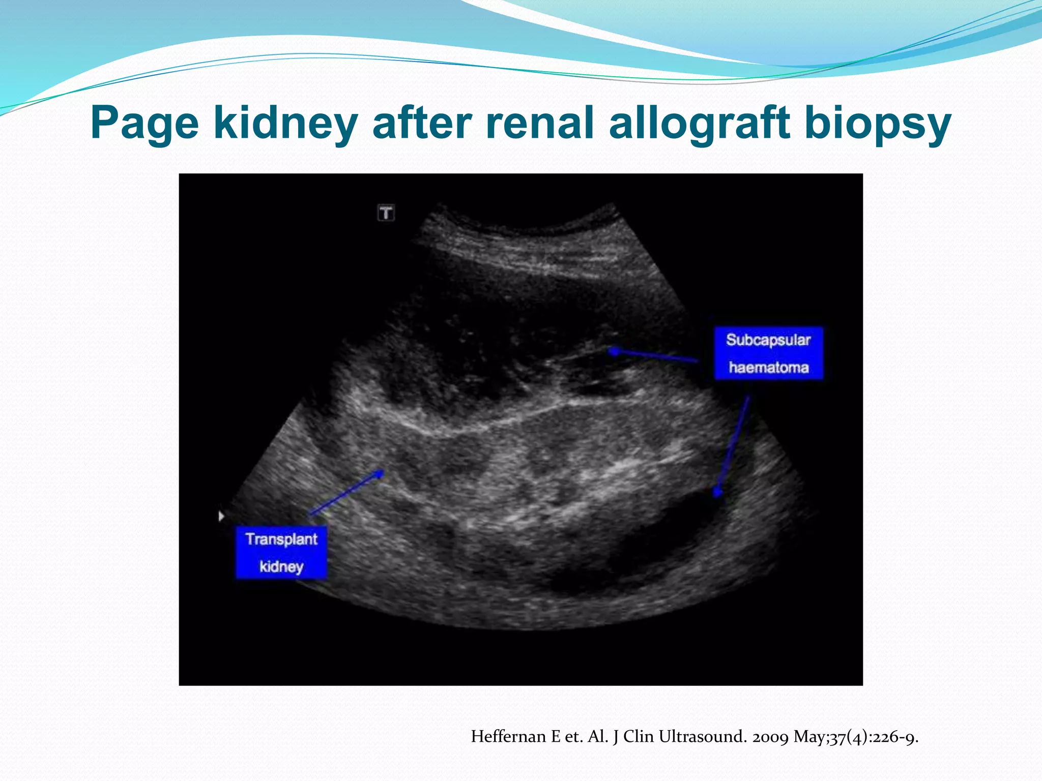 Early diagnosis of graft rejection in renal transplantation | PPTX ...