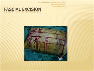 Early excision and skin grafting in burns by Dr. Sunil Keswani ...