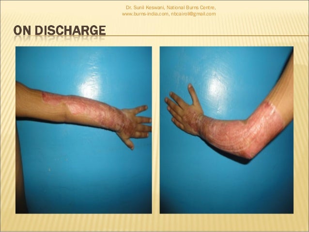Early excision and skin grafting in burns by Dr. Sunil Keswani, Natio…
