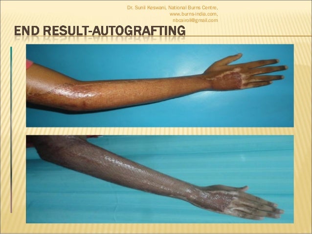Early excision and skin grafting in burns by Dr. Sunil Keswani, Natio…
