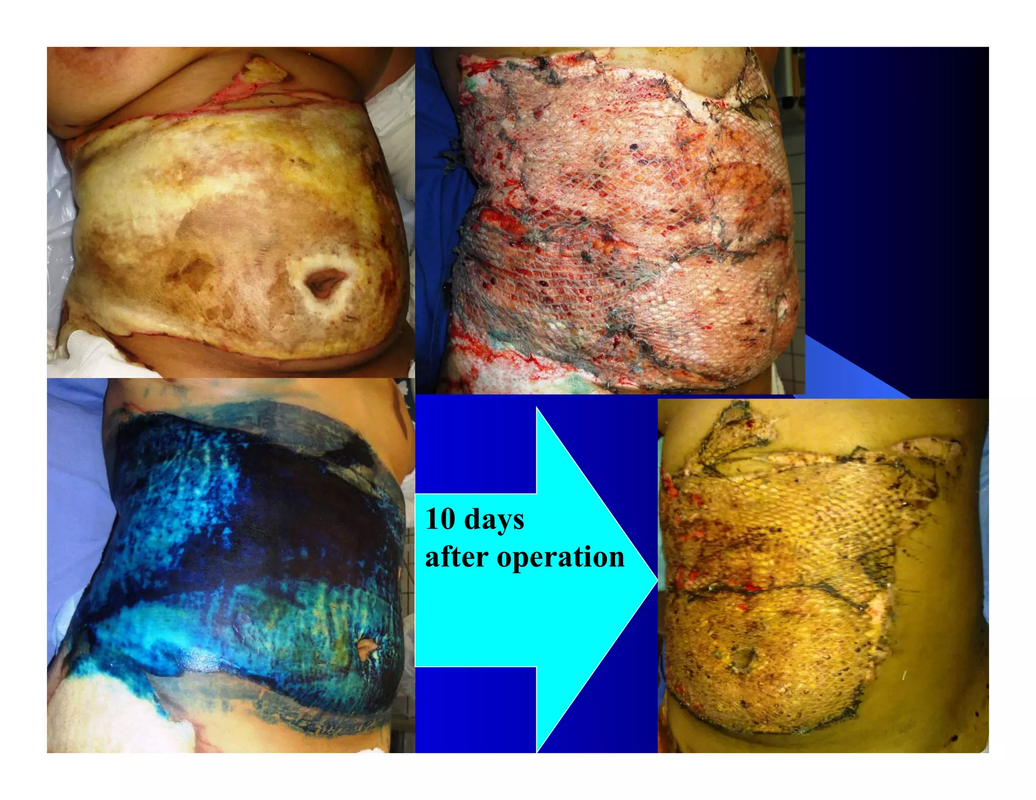 Early excision &skin grafting with M.Blue guide by dr. qutaiba aldoori ...