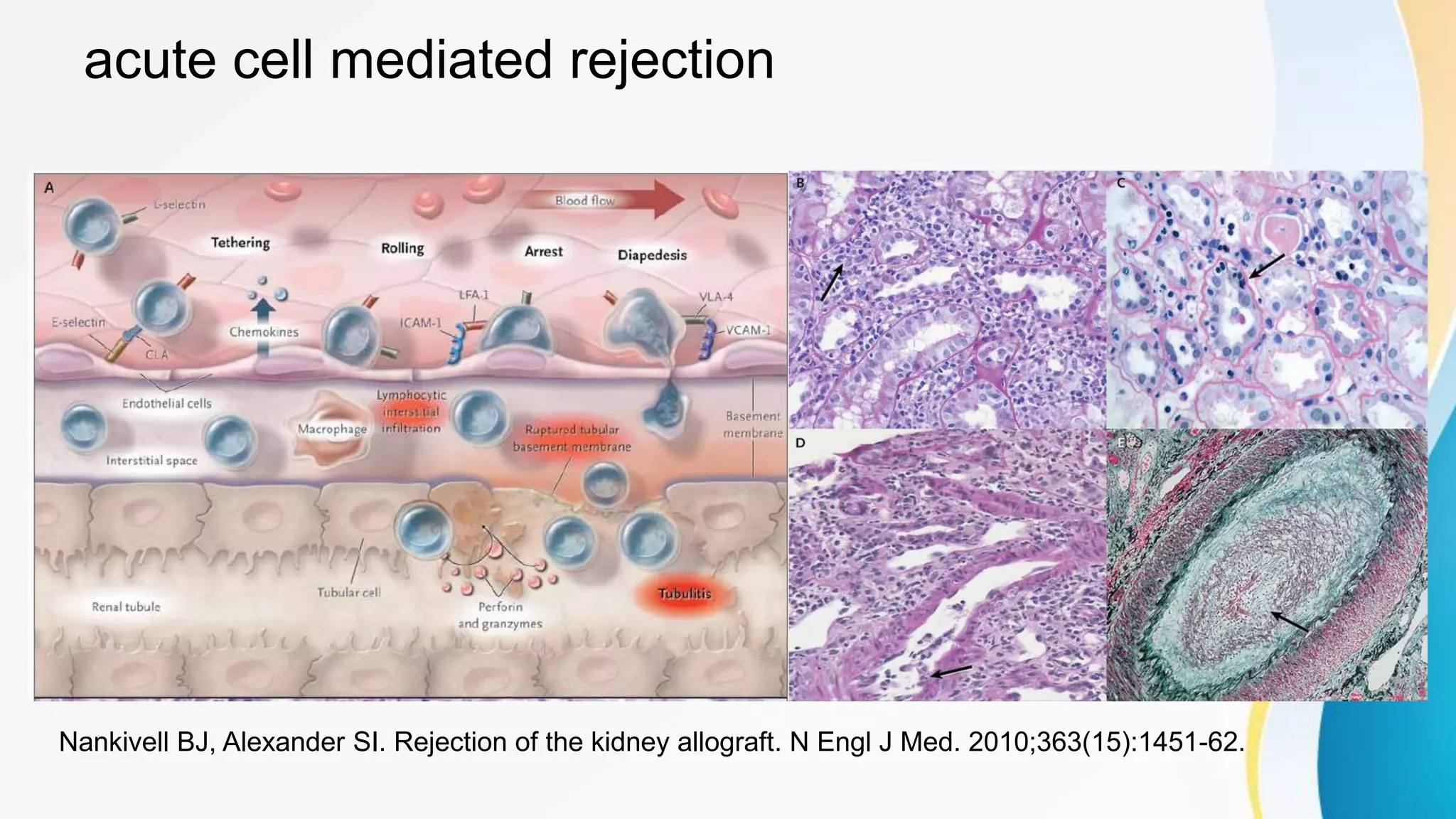 Early graft dysfunction | PPTX