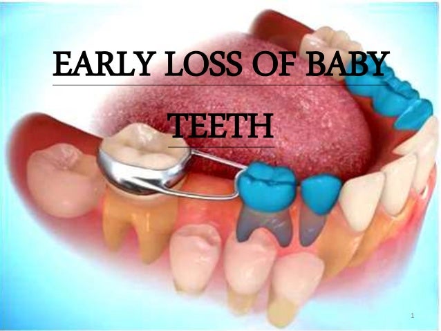 Premature Loss of Baby Teeth | Teeth Loss