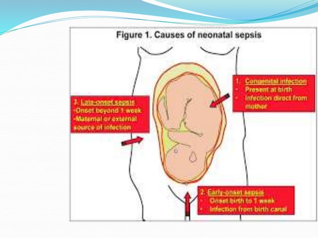 Early neonatal sepsis | PPTX