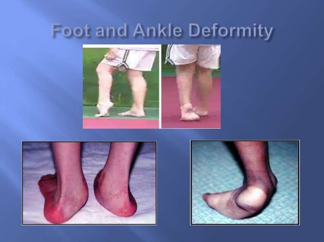 Early Physiotherapy and Management of Deformities.pptx
