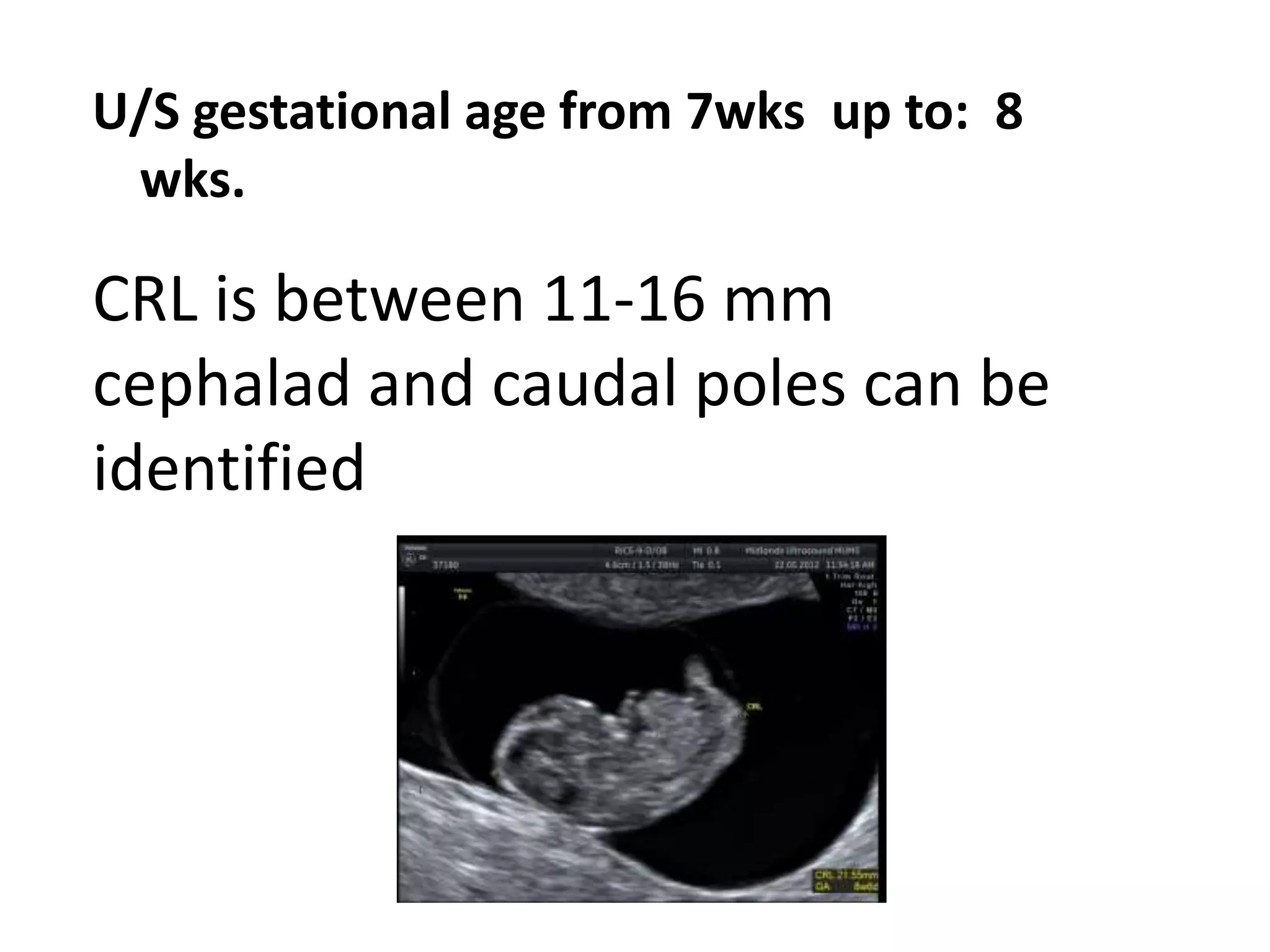 Ultrasound diagnosis of early pregnancy and cutoff measurements of ...