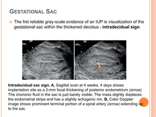 utrasound in Early pregnancy | PPTX
