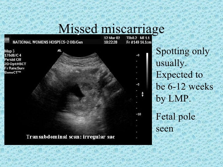 Miscarriage Symptoms At 6 Weeks