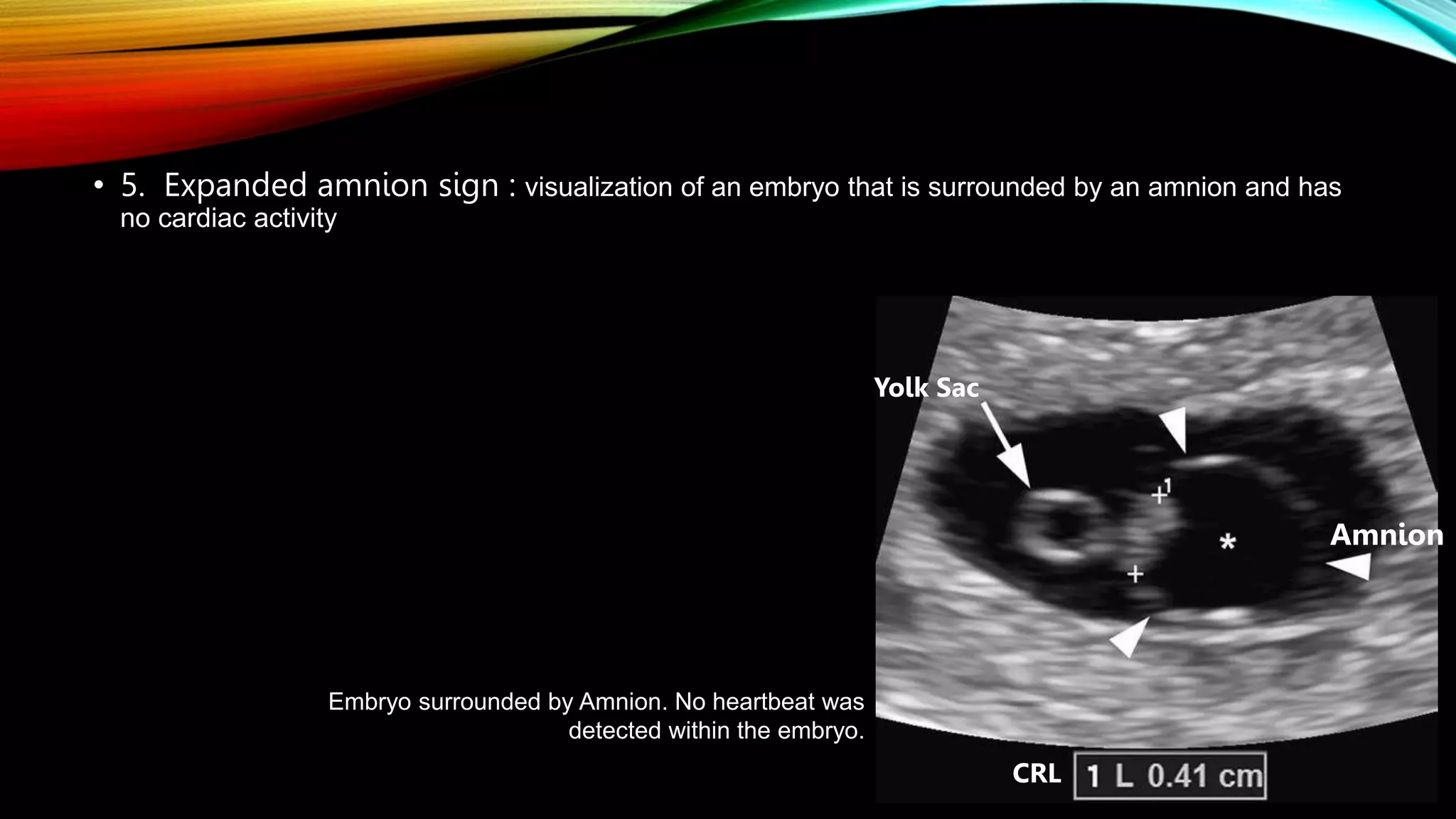 EARLY Pregnancy failure.pptx