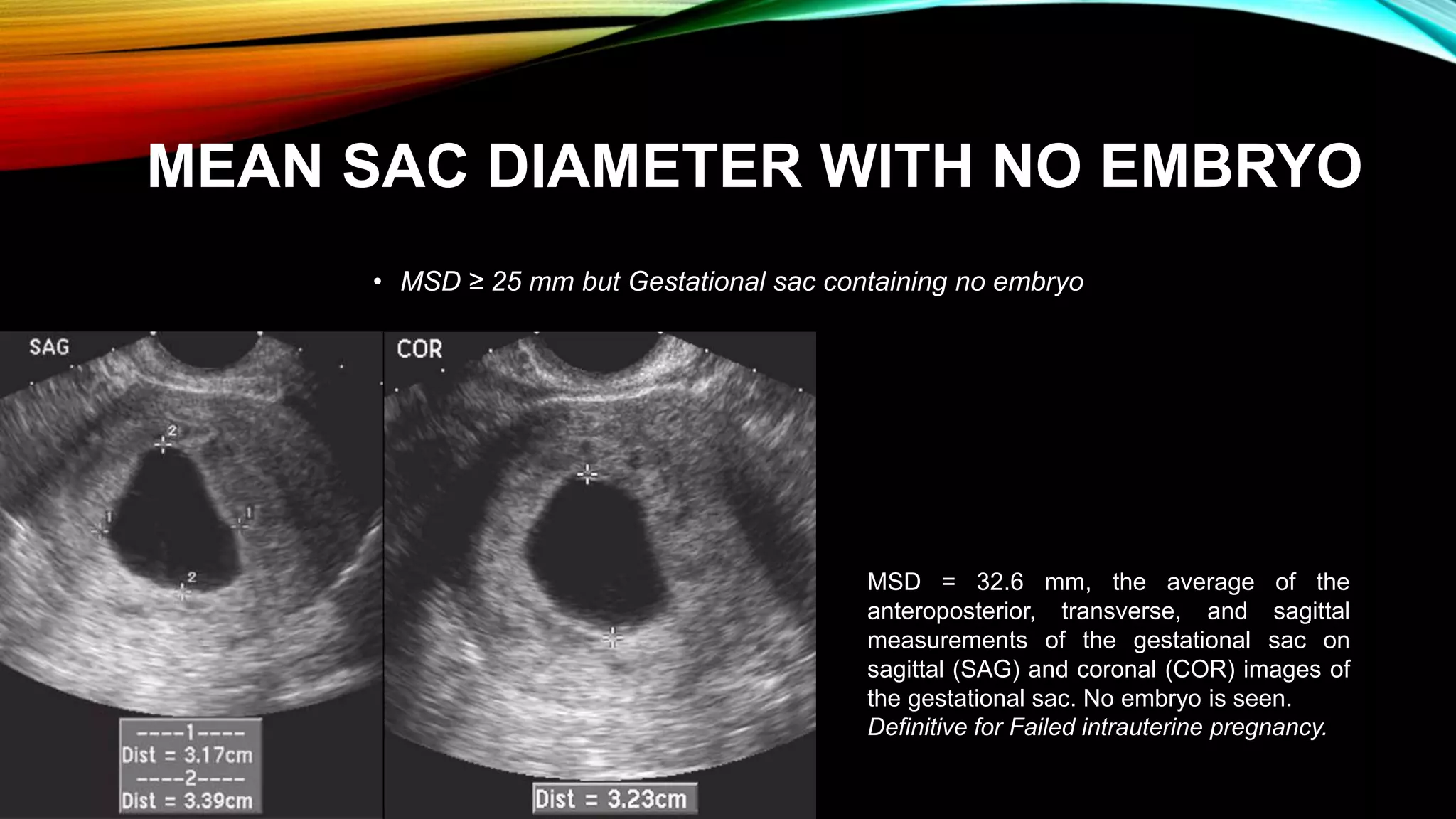 EARLY Pregnancy failure.pptx
