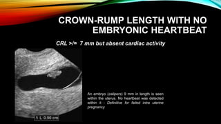 EARLY Pregnancy failure.pptx