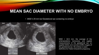 EARLY Pregnancy failure.pptx