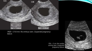 EARLY Pregnancy failure.pptx
