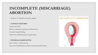 Early pregnancy loss | PPTX