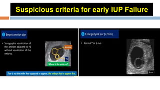 Early Pregnancy Loss a Simplified Ultrasound Approche Dr/ Ahmed Walid ...