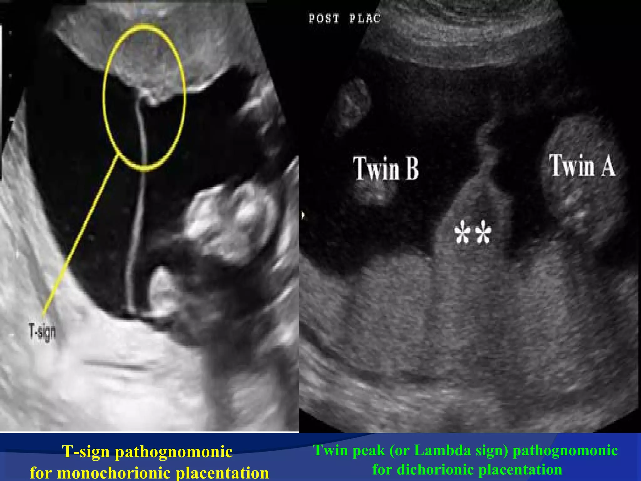 Early pregnancy ultrasonographic evaluation | PPT