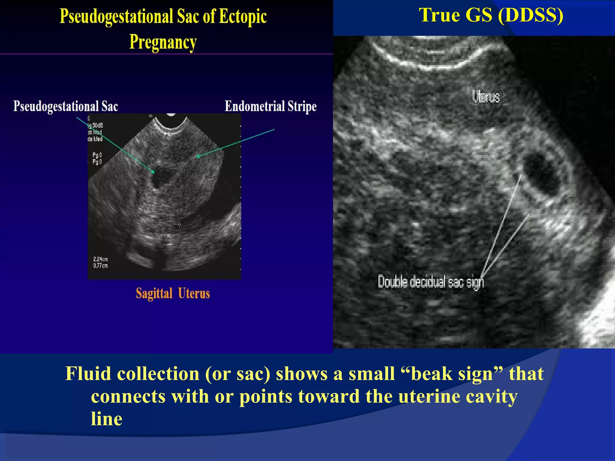 Early pregnancy ultrasonographic evaluation | PPT