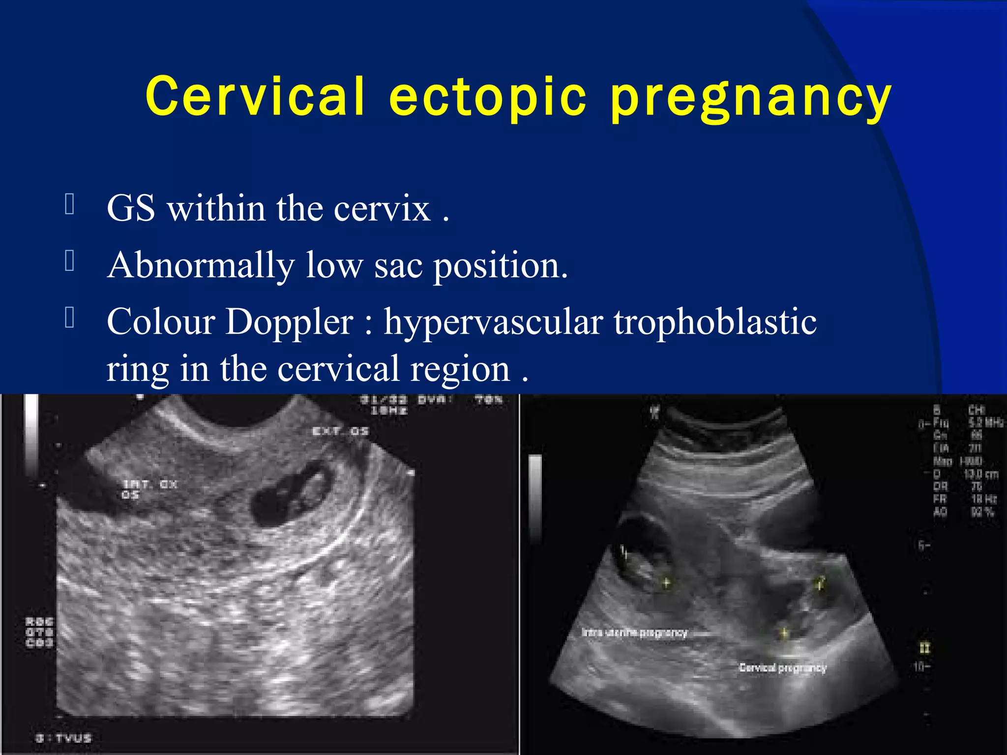 Early pregnancy ultrasonographic evaluation | PPT