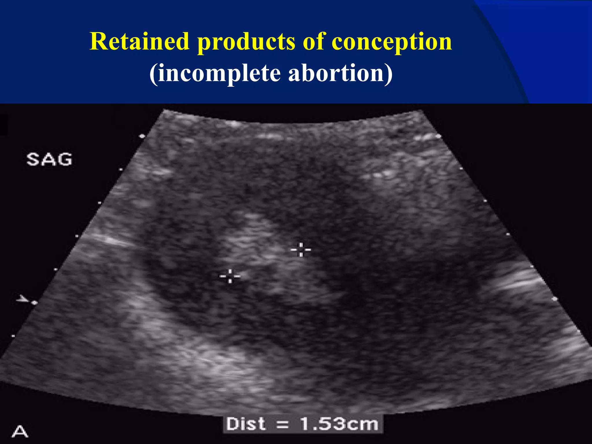 Early pregnancy ultrasonographic evaluation | PPT