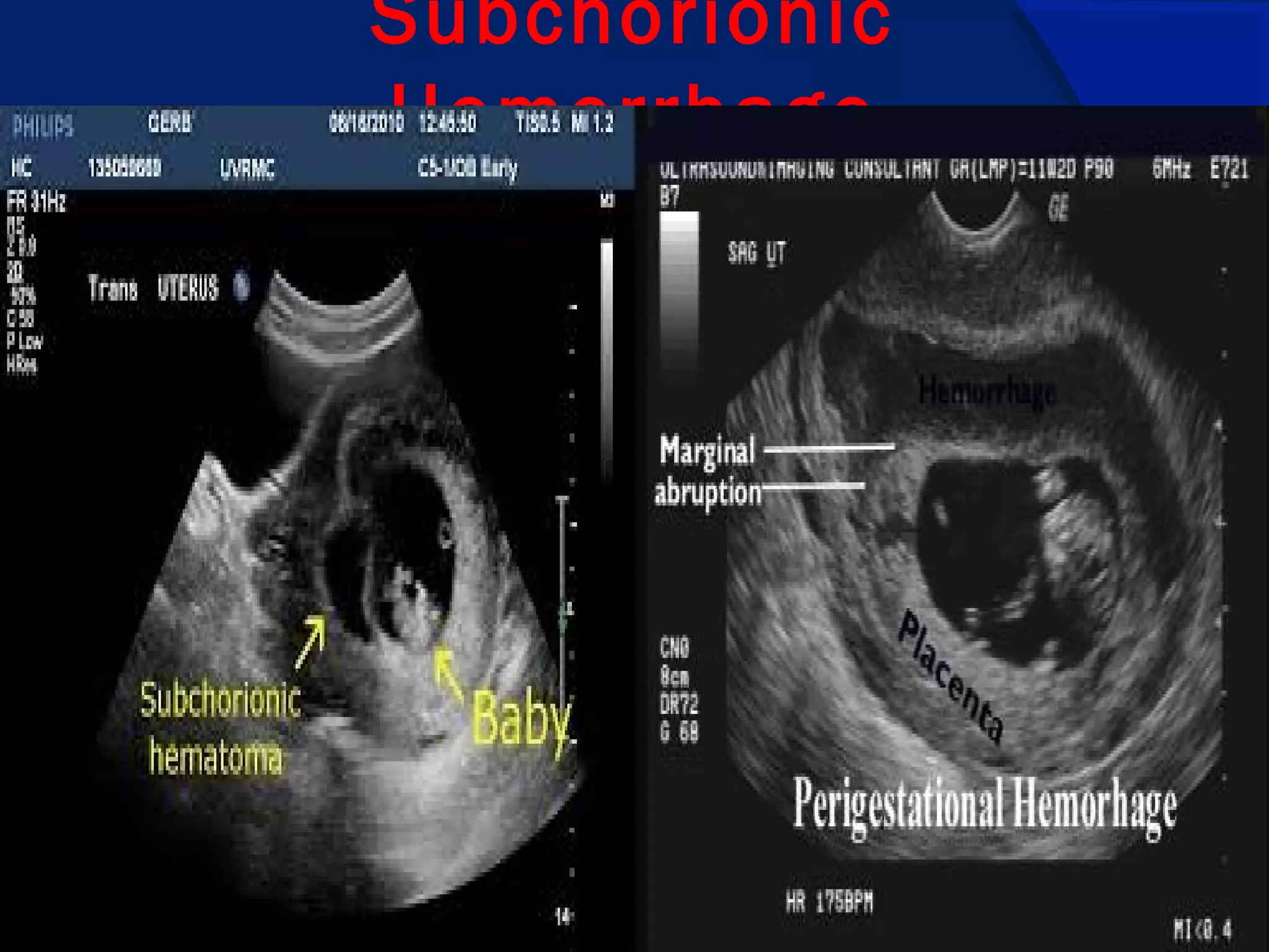 A Routine Prenatal Ultrasound Can Identify Early Signs – FFDW