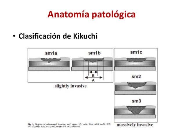 Early rectal cancer. cancer de recto incial