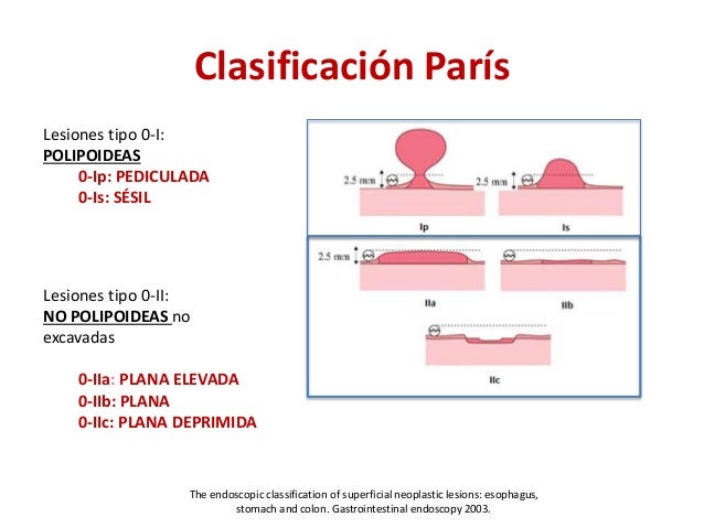 Early rectal cancer. cancer de recto incial