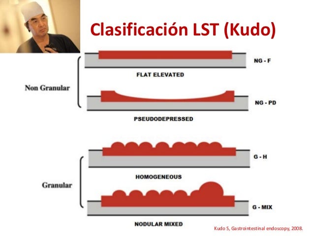 Early rectal cancer. cancer de recto incial