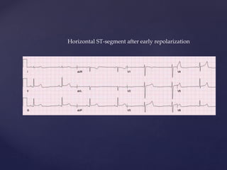 Early repolarisation syndrome (2) | PPTX