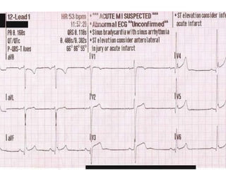 Early repolarization: Safety Profile | PPT