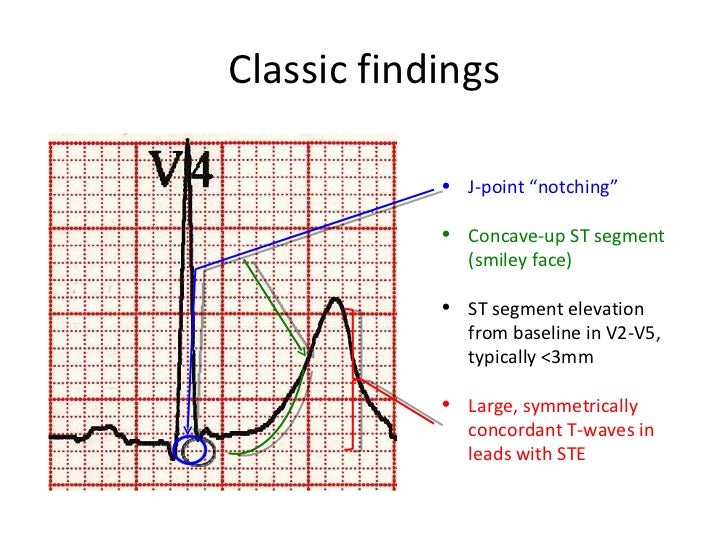 Early repolarization: Safety Profile