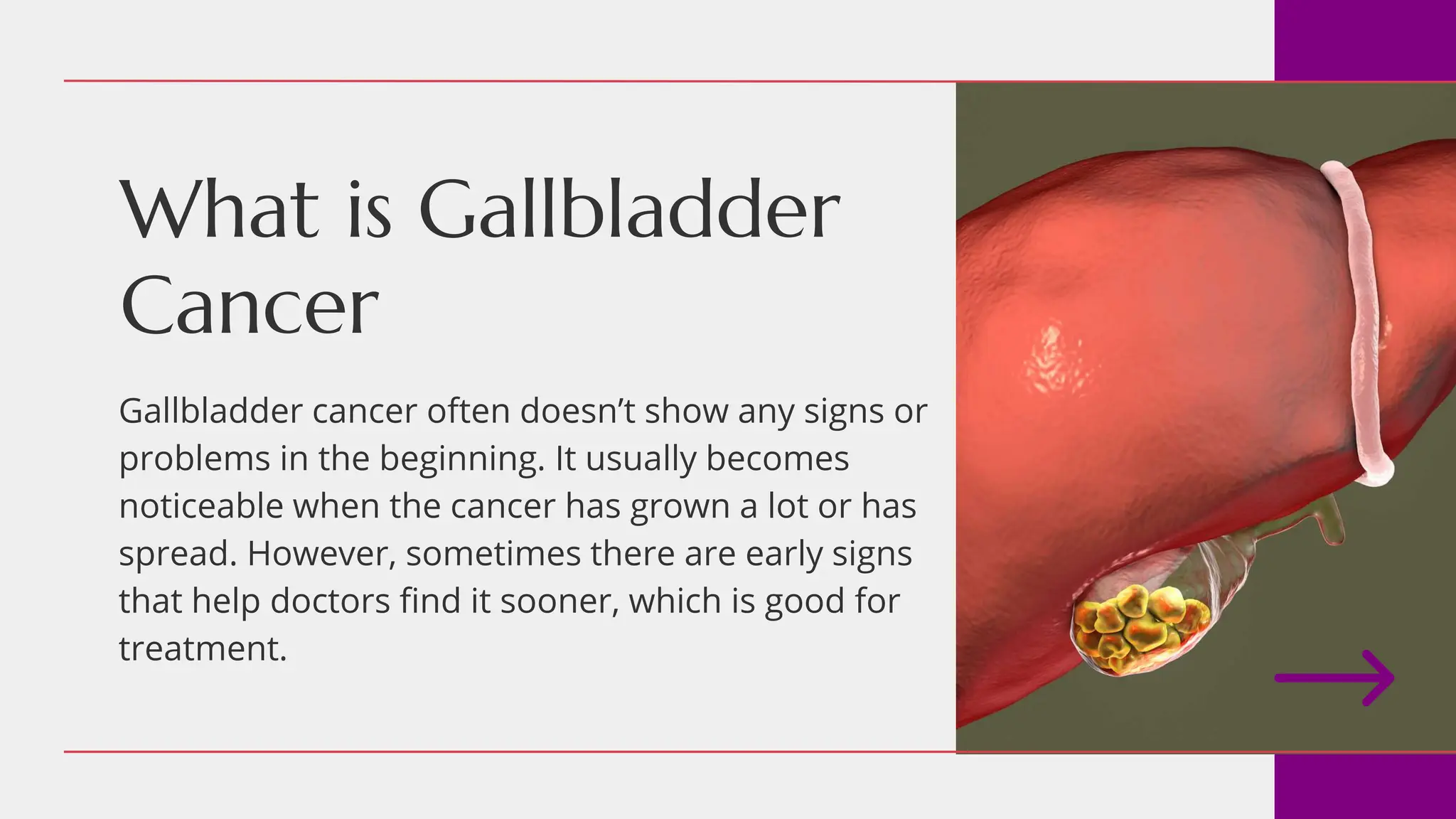 Early Signs of Gallbladder Cancer guidance | PPTX