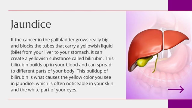 Early Signs of Gallbladder Cancer guidance | PPTX