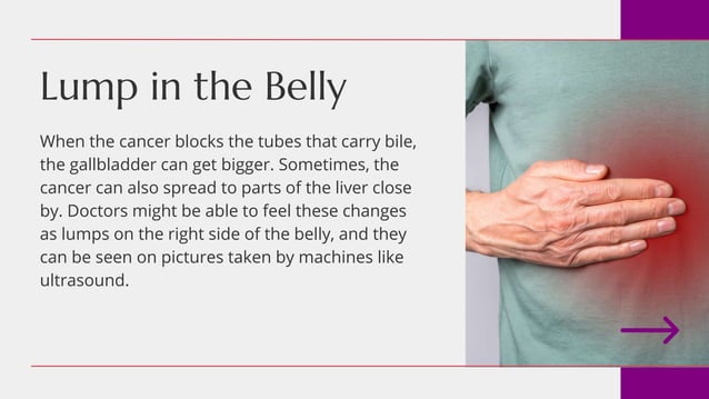 Early Signs of Gallbladder Cancer guidance | PPTX
