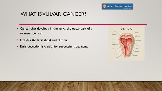 Early Signs and Symptoms of Vulvar Cancer | PDF