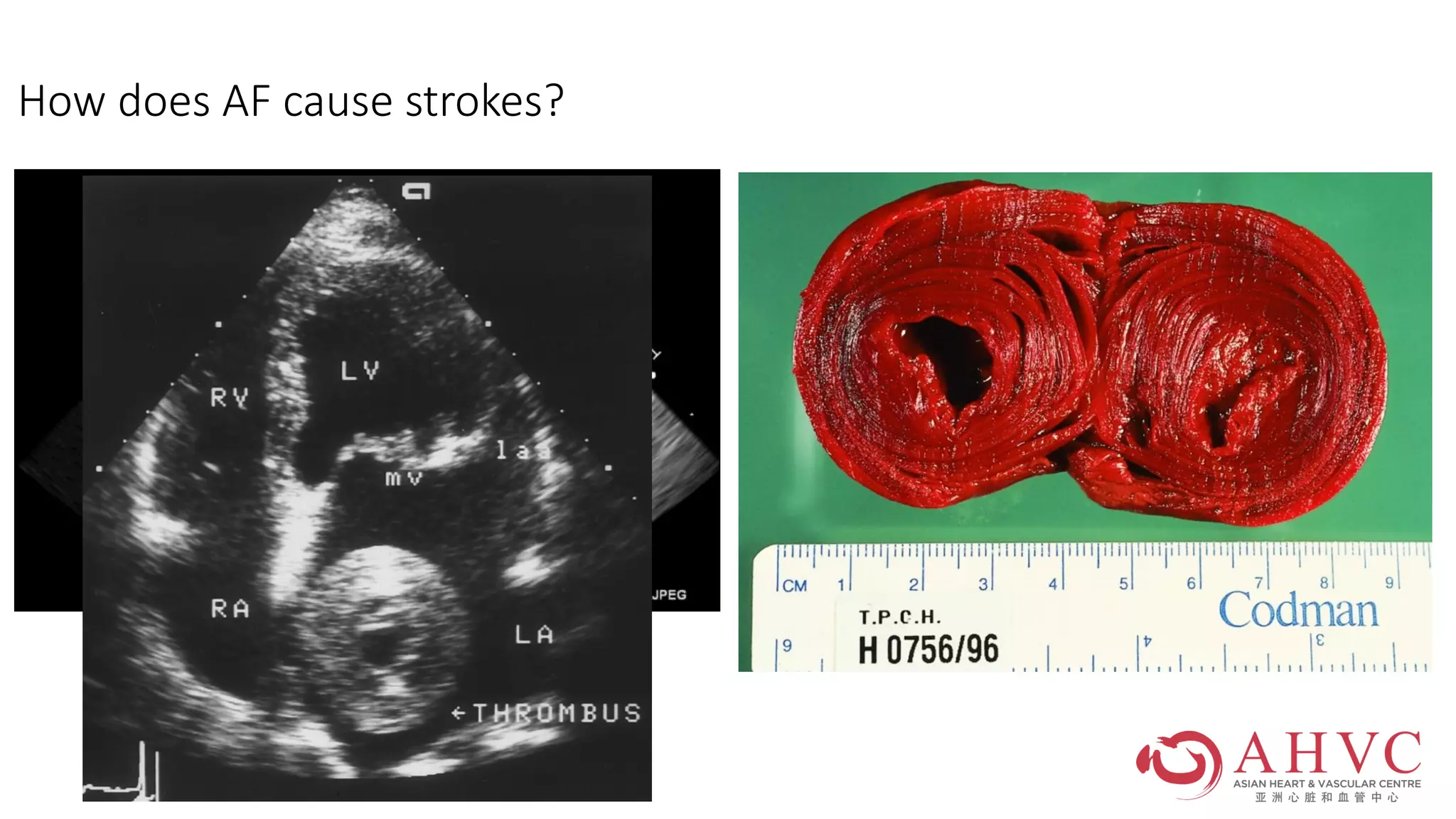 Early Treatment of Atrial Fibrillation (AF) - By Dr Pipin Kojodjojo ...