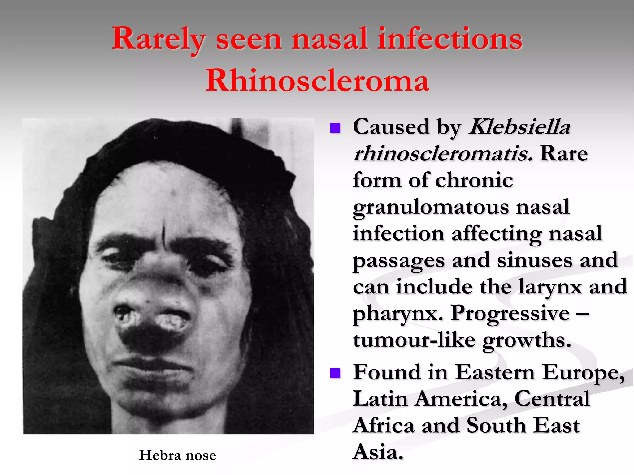 Ear, nose and throat infections dr.ihsan alsaimary | PPT