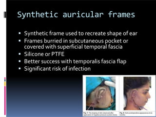 ear reconstruction.pptx