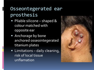 ear reconstruction.pptx