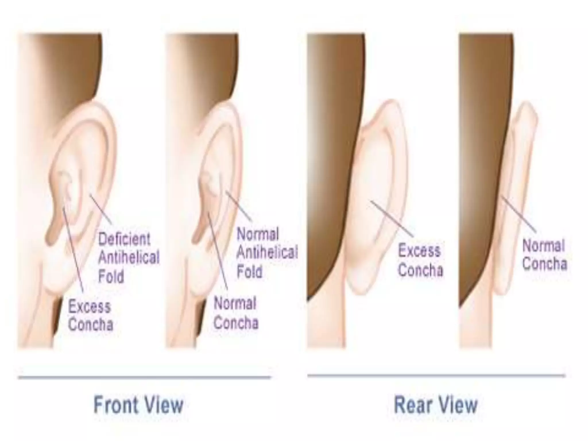 Ear reconstruction tamilnadu | PPTX