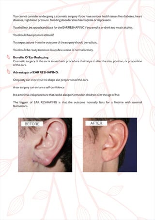 Ear Reshaping Surgery ( Otoplasty ) - What it is, Benefits, Procedure ...
