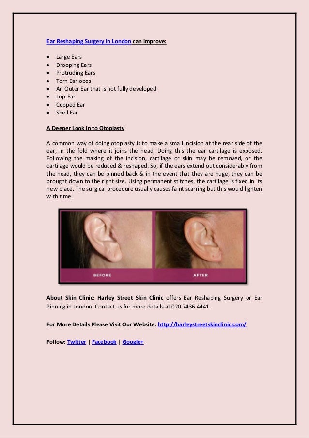 Ear Reshaping Surgery (Otoplasty) - Plastic Surgery Ear Reshaping Surgery (Otoplasty) - Plastic Surgery