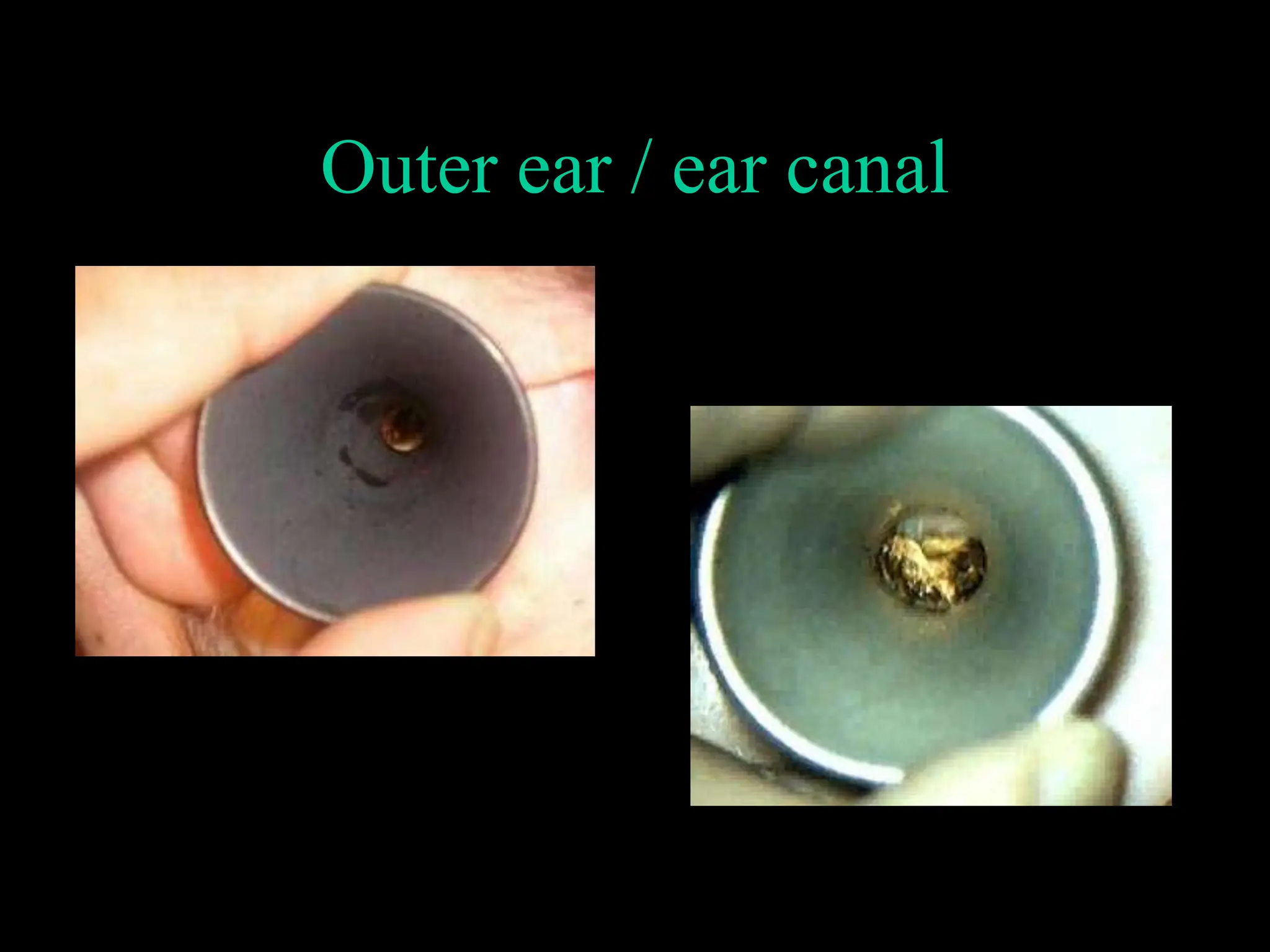 Ears, anatomy and otoscopic pathology, pictures and diagrams.ppt