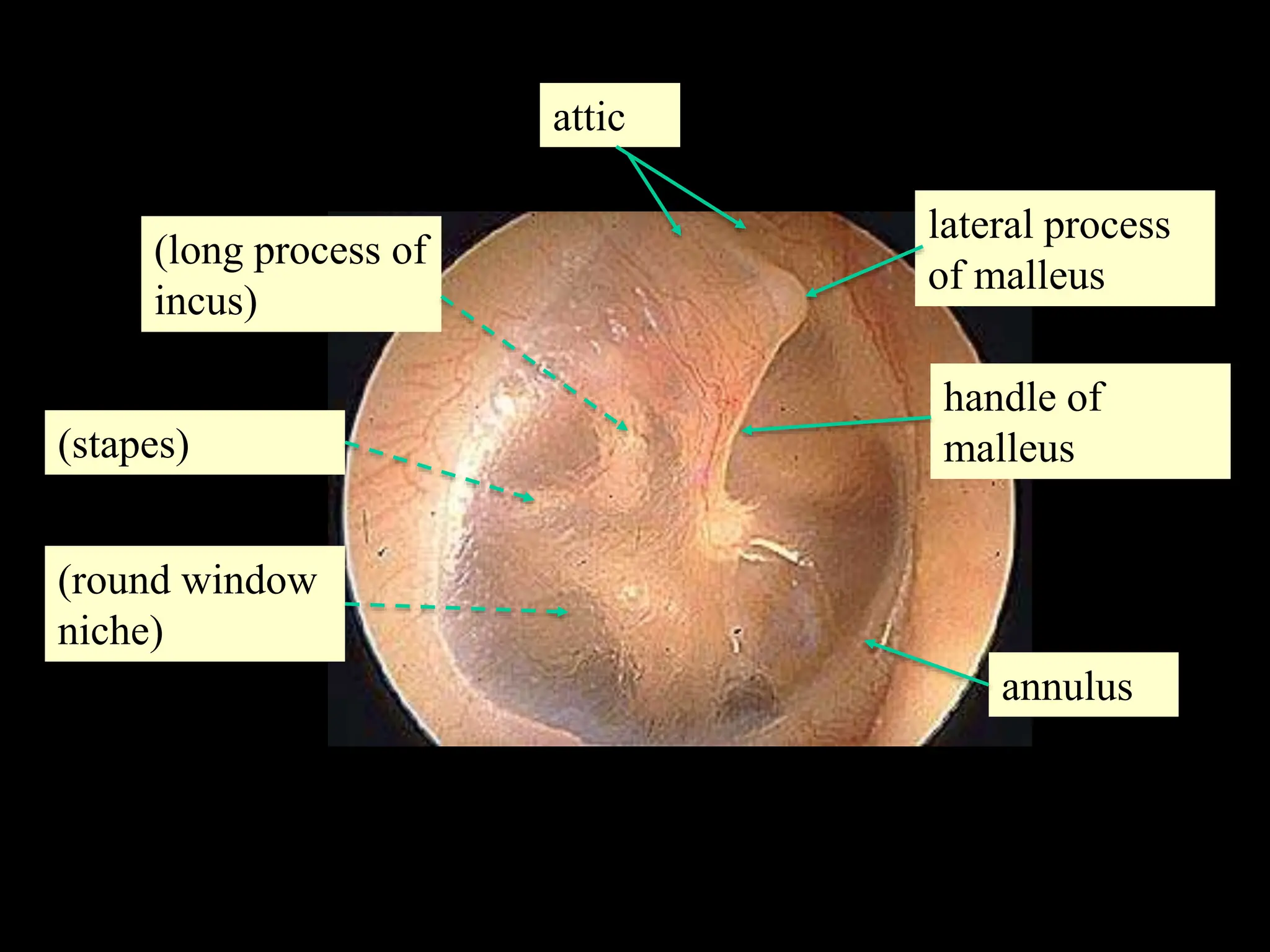 Ears, anatomy and otoscopic pathology, pictures and diagrams.ppt