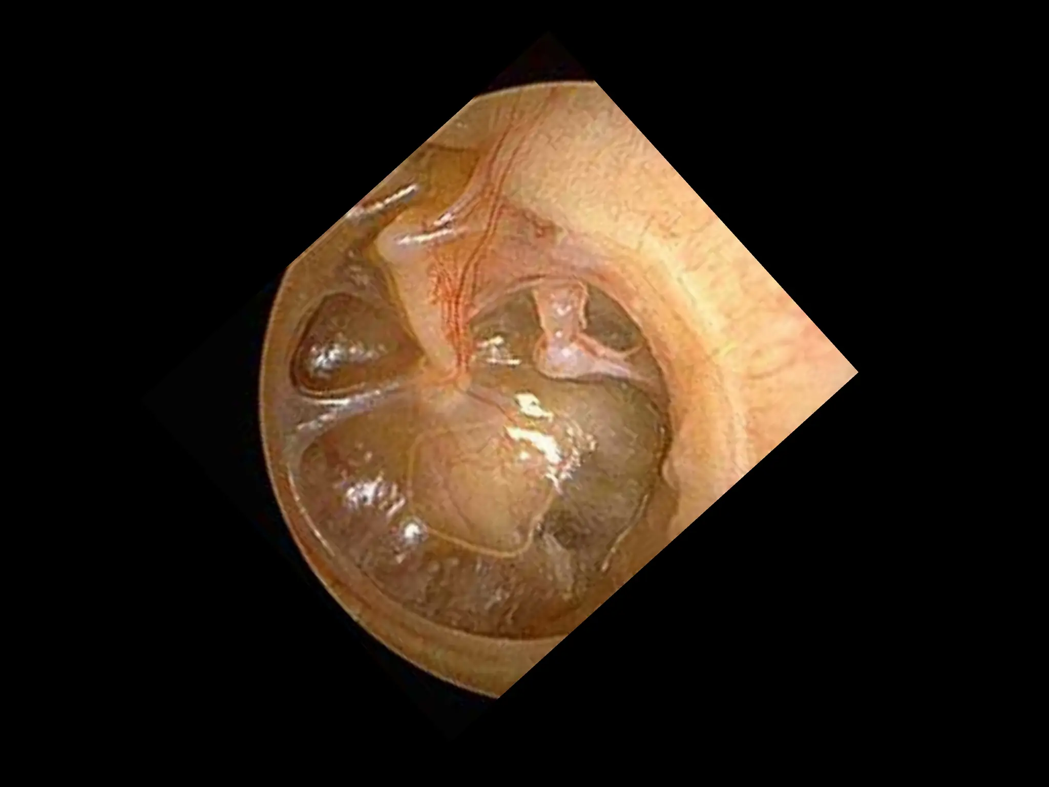 Ears, anatomy and otoscopic pathology, pictures and diagrams.ppt