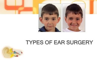 Ear surgery | PPTX