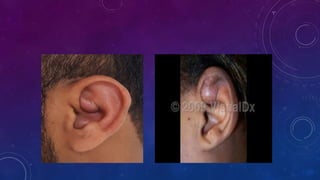 Ear trauma | PPTX