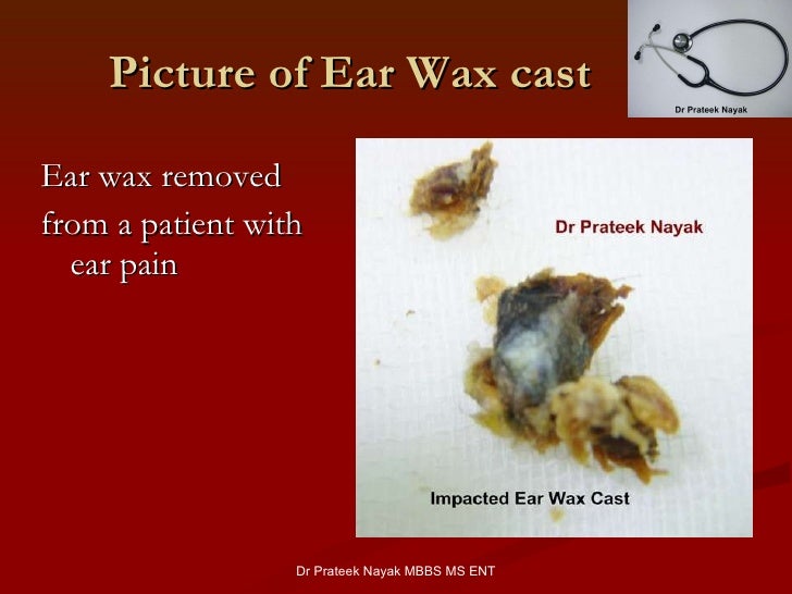 Ear Wax - by ENT Specialist Bangalore Dr Prateek Nayak Ear Wax - by ENT Specialist Bangalore Dr Prateek Nayak