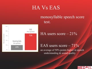 Electro Acoustic Stimulation ( EAS ) | PPT