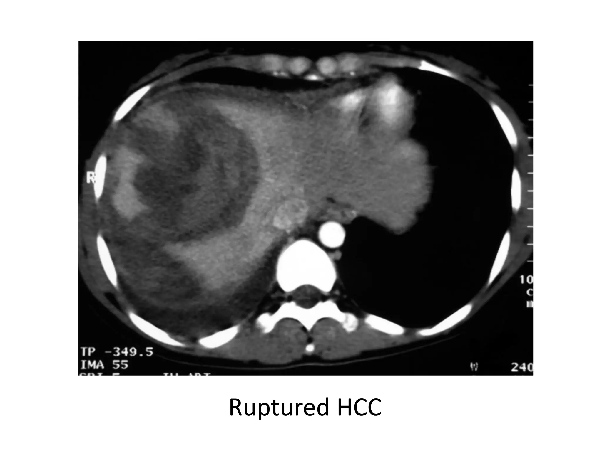 Surgery at the Borderline in HCC patient - EASL Conference - Vienna ...